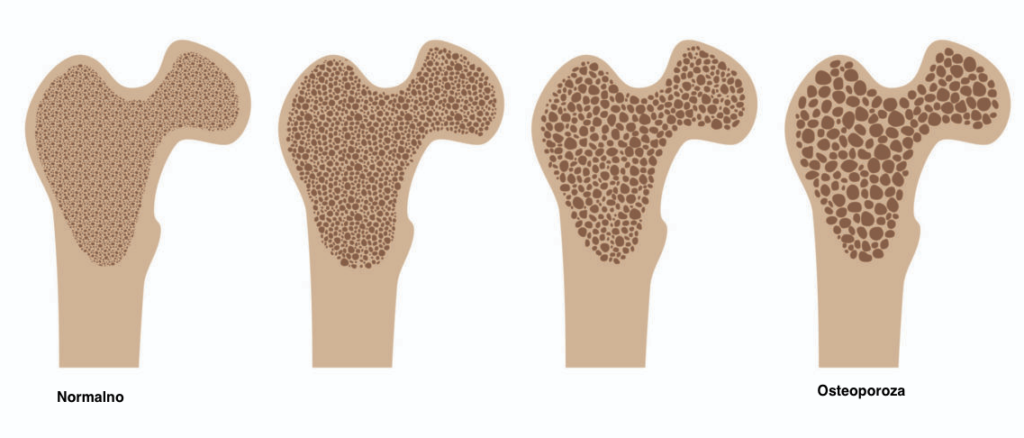 Šta je osteoporoza i kako ojačati svoje kosti da bi sprečili prelome?