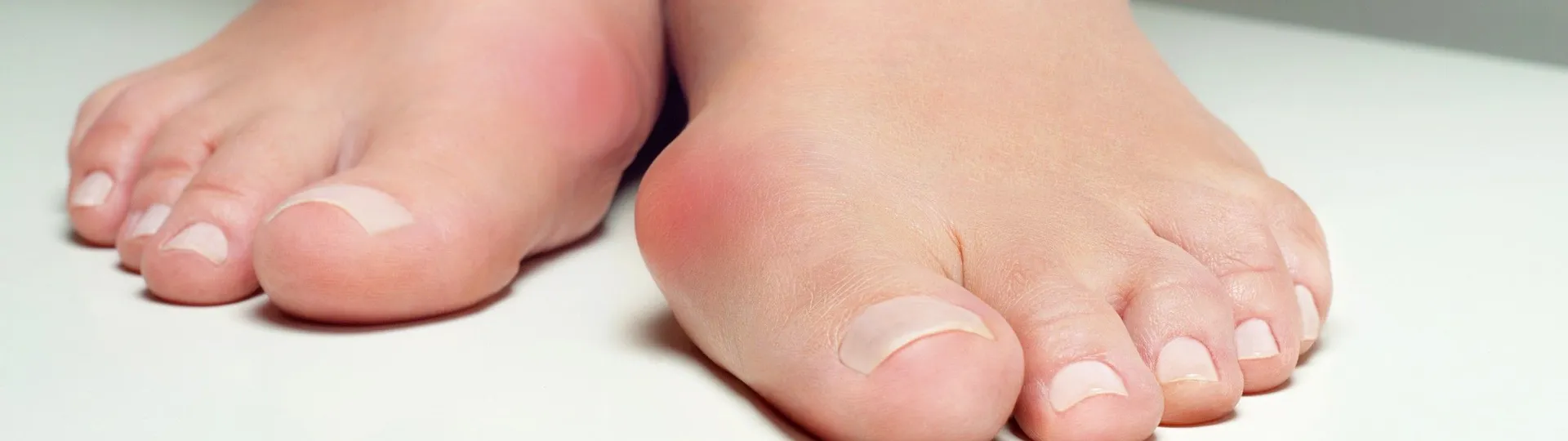 Kako Prirodno Lečiti Čukljeve na Nogama: Saveti i Metode